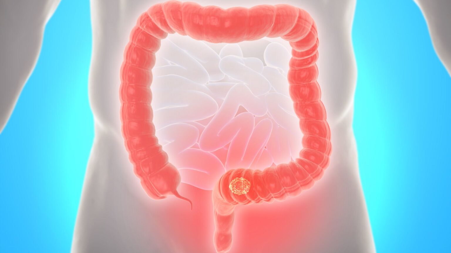 Capsule Endoscopy - Texas Gastroenterology Center PLLC